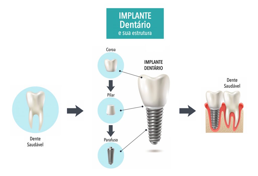 Partes Do Implante Dentário _ Morfologia dos implantes dentários – OWMOVG